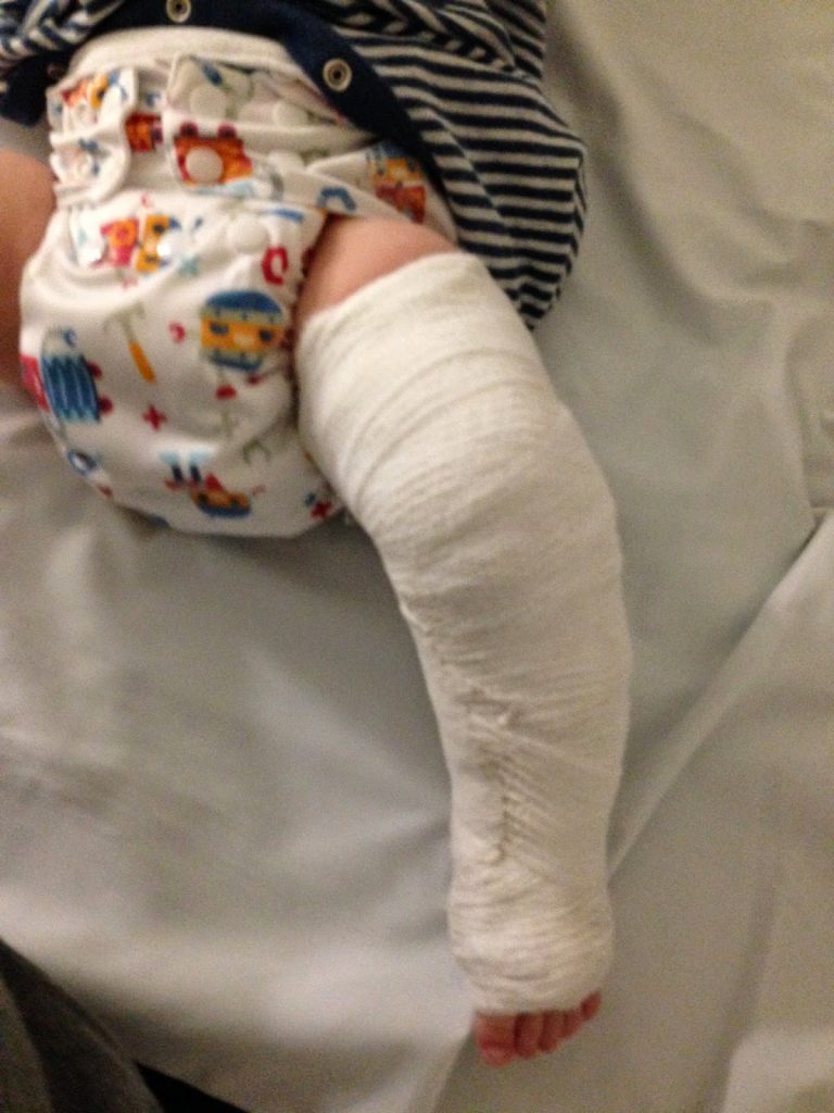 My baby had a Fractured leg – Yes you read that right!